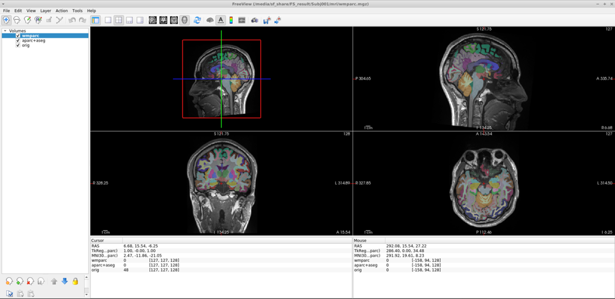 【FreeSurfer】FreeSurferを用いた脳構造解析