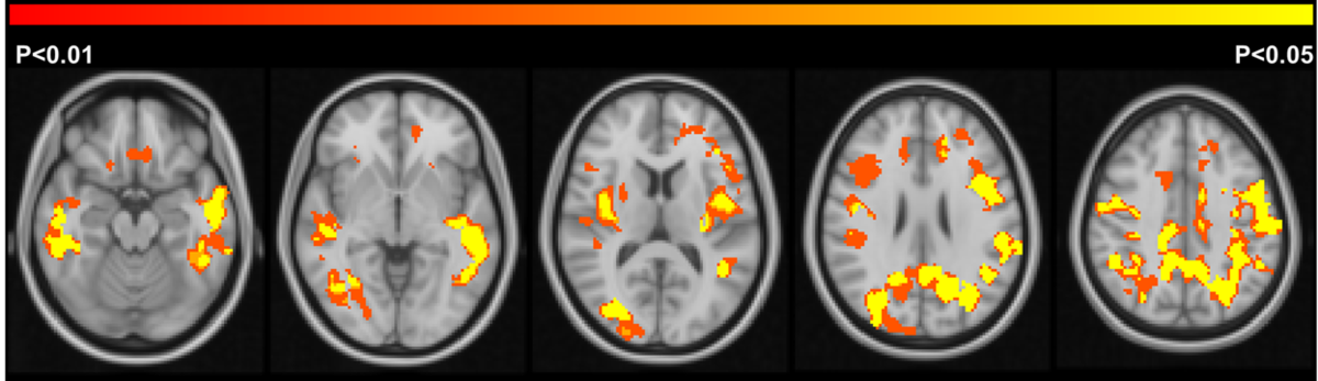 【FSL】FSLを用いたVoxel-Based Morphometry: VBM