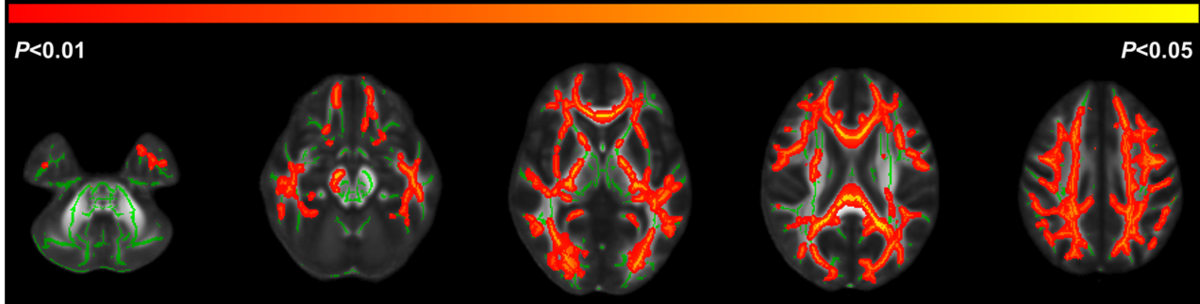 【FSL】Tract-Based Spatial Statistics: TBSS